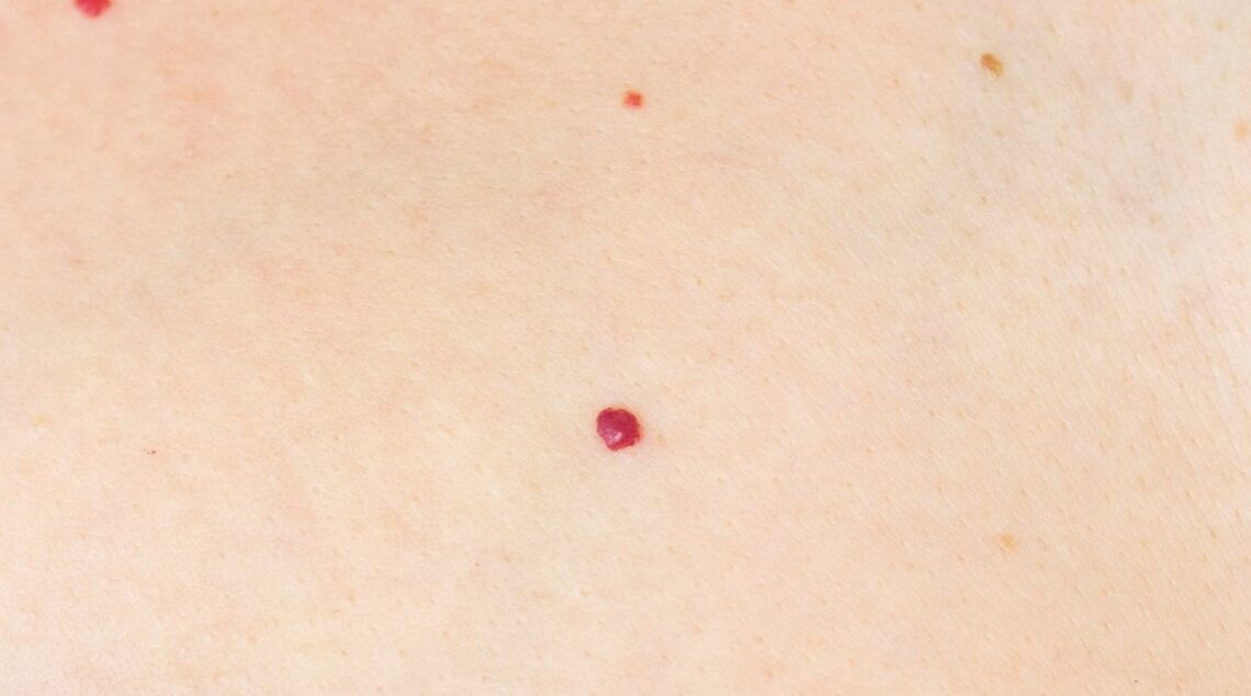 C'est quoi ces petits points rouges sur la peau ? L'avis d'un ...